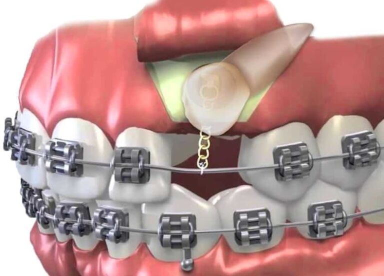Ortho exposure and bond - Montour Oral Surgery